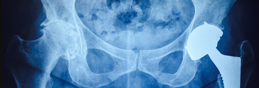 Symptômes de l'arthrose de hanche ou coxarthrose